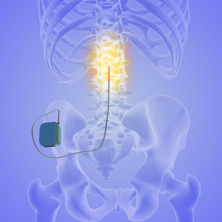 Complex Regional Pain Syndrome (CRPS) | CRPS Pain Relief | Alabama ...
